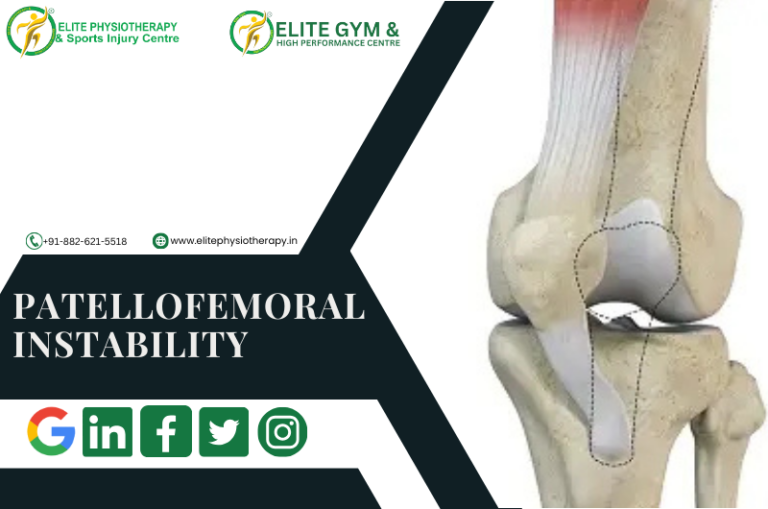 Patellofemoral Instability Archives - Elite Physio Therapy