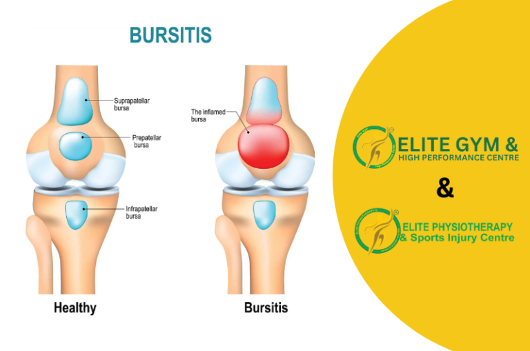 Knee Bursitis: Knee Pain Treatment