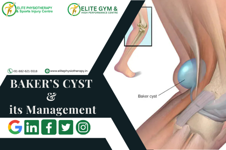 Baker’s Cyst and Its Comprehensive Management