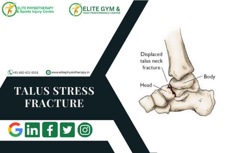 Talus Stress Fracture: And its non surgical treatment- Elite Physio Therapy