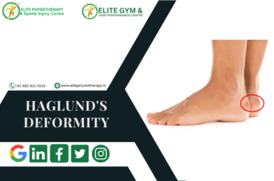 Haglund's Deformity: Causes, Symptoms, and Physiotherapy | Elite