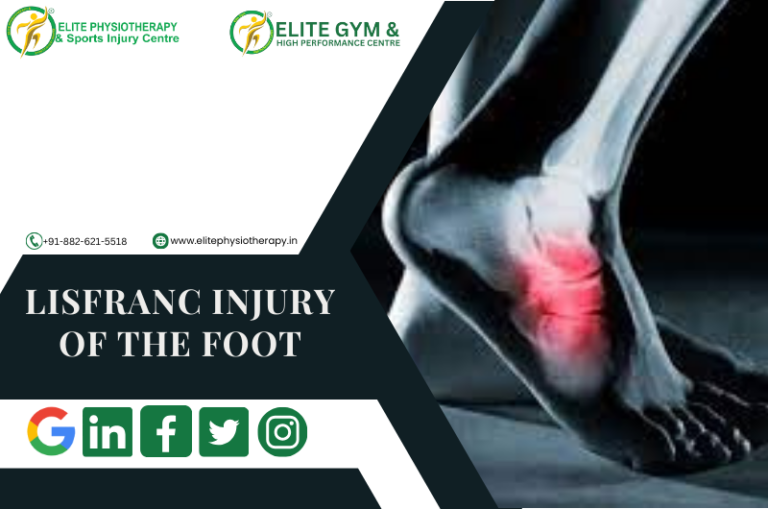 Lisfranc injury of the Foot and its Physiotherapy | Elite Physio