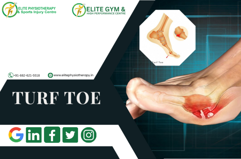TURF TOE | TOE INJURY and its Physiotherapy Management