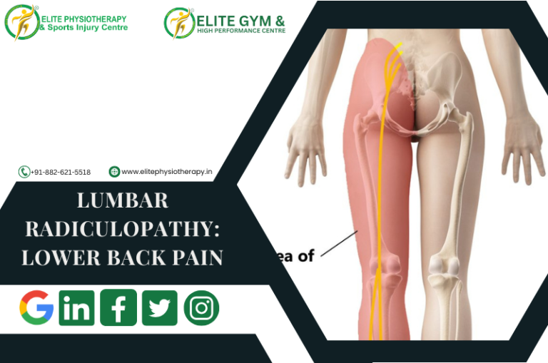 Lumbar Radiculopathy: Lower Back Pain | Elite Physiotherapy