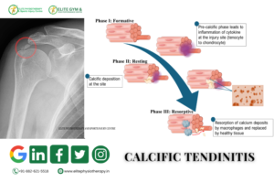 Calcific tendinitis what is it and how to manage | Elite Physiotherap